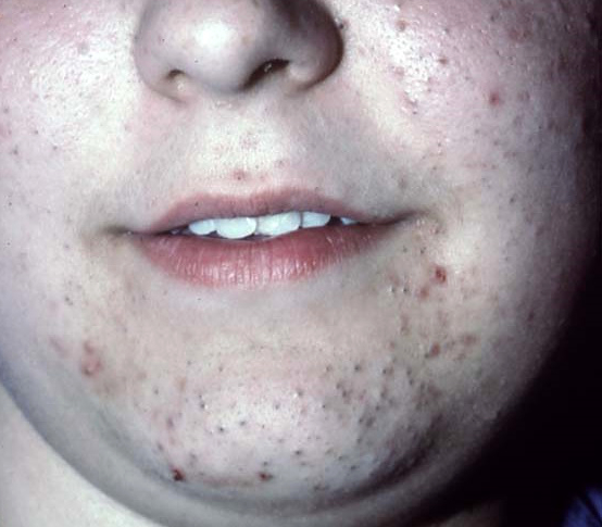 Lésions élémentaires de l'acné, Centre de Preuves en Dermatologie