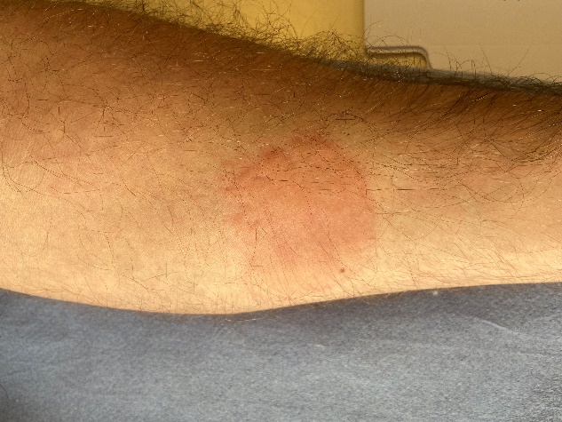 Lésions élémentaires de l'urticaire au froid, Centre de Preuves en ...